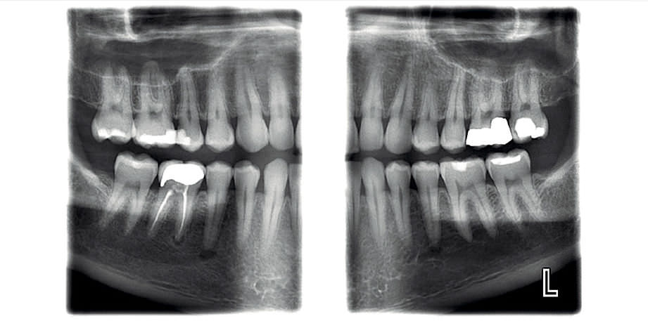 Everything You Need to Know About Extraoral Bitewings - Renew Digital, LLC